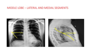 BRONCHO PULMONARY SEGMENTS of lung .pptx