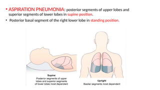 BRONCHO PULMONARY SEGMENTS of lung .pptx