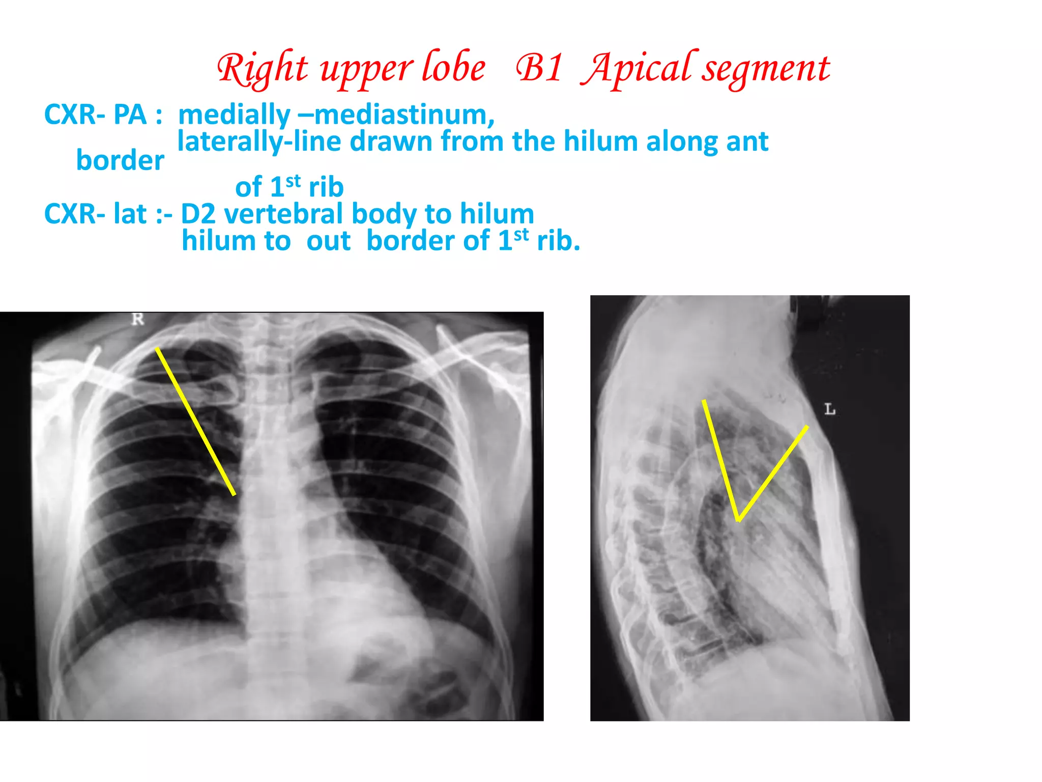 BRONCHOPULMONARY SEGMENTS OF THE LUNG | PPTX