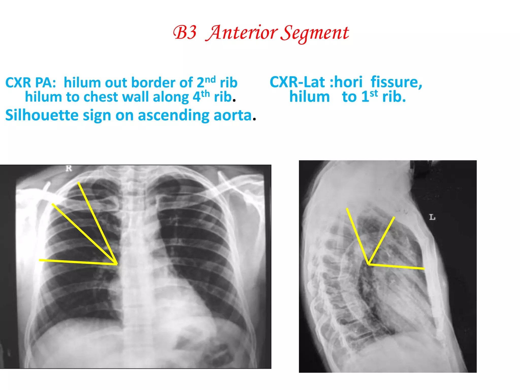 BRONCHOPULMONARY SEGMENTS OF THE LUNG | PPTX | Death, Injury, or ...