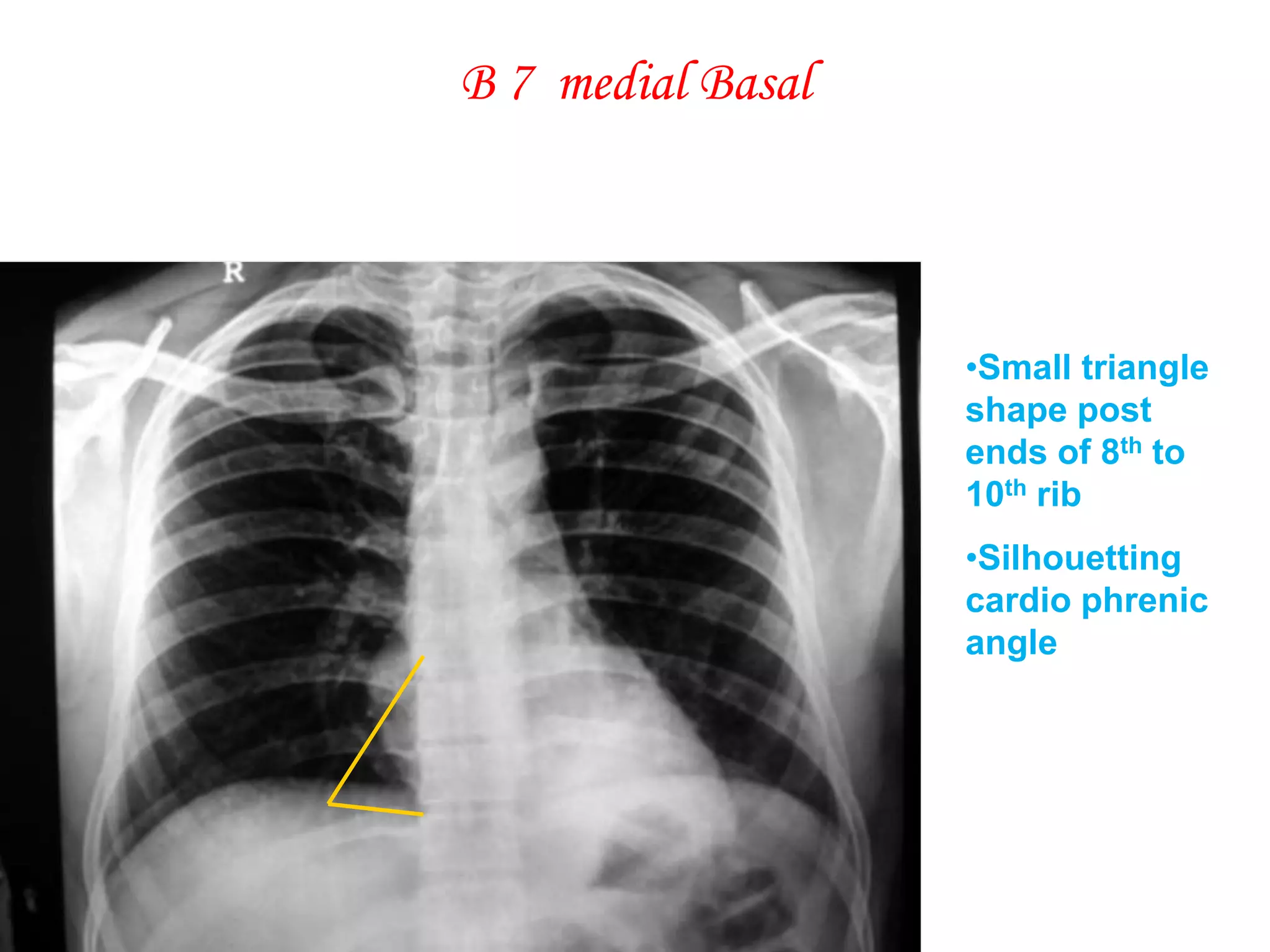 BRONCHOPULMONARY SEGMENTS OF THE LUNG | PPTX