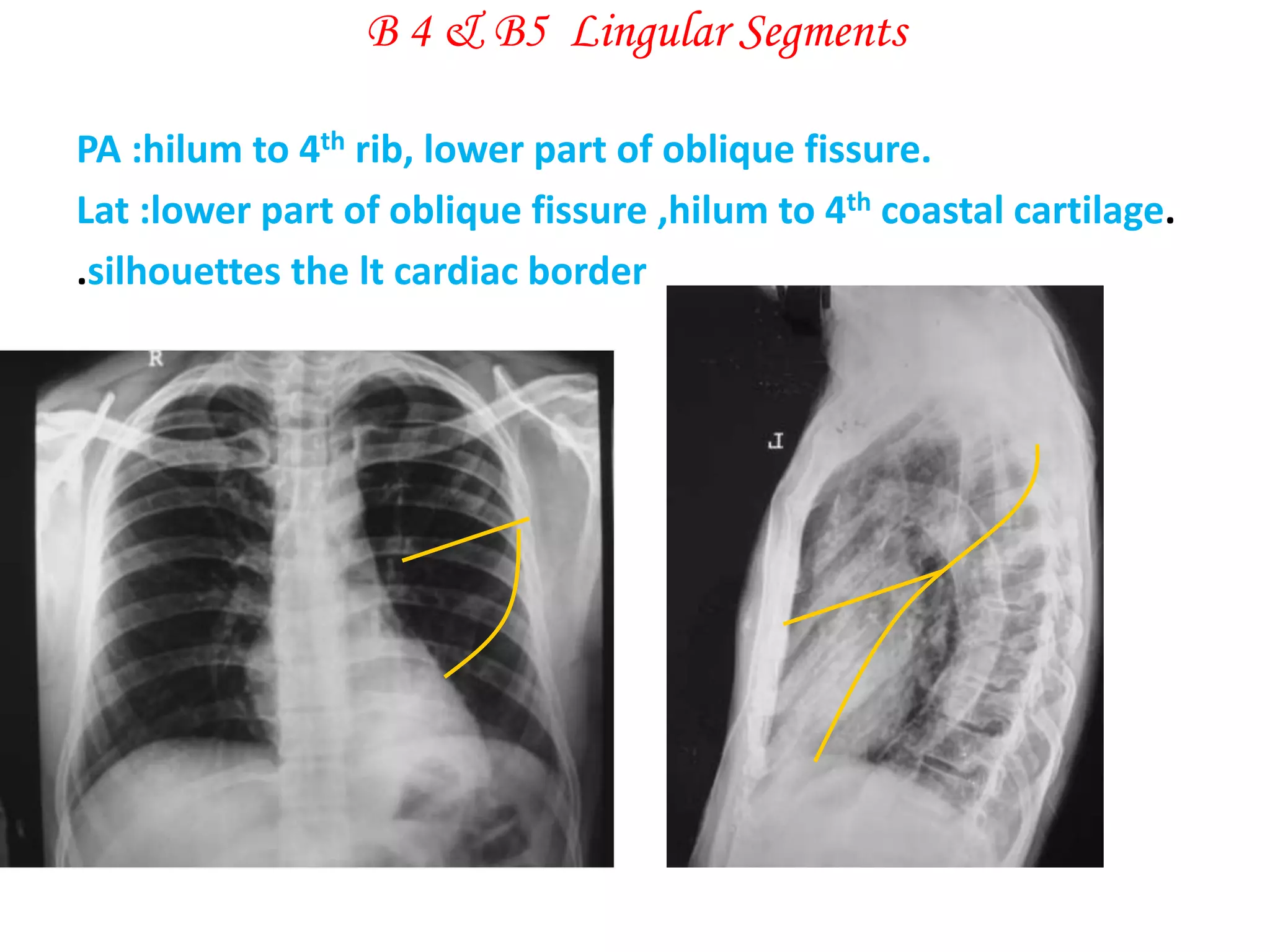 BRONCHOPULMONARY SEGMENTS OF THE LUNG | PPTX