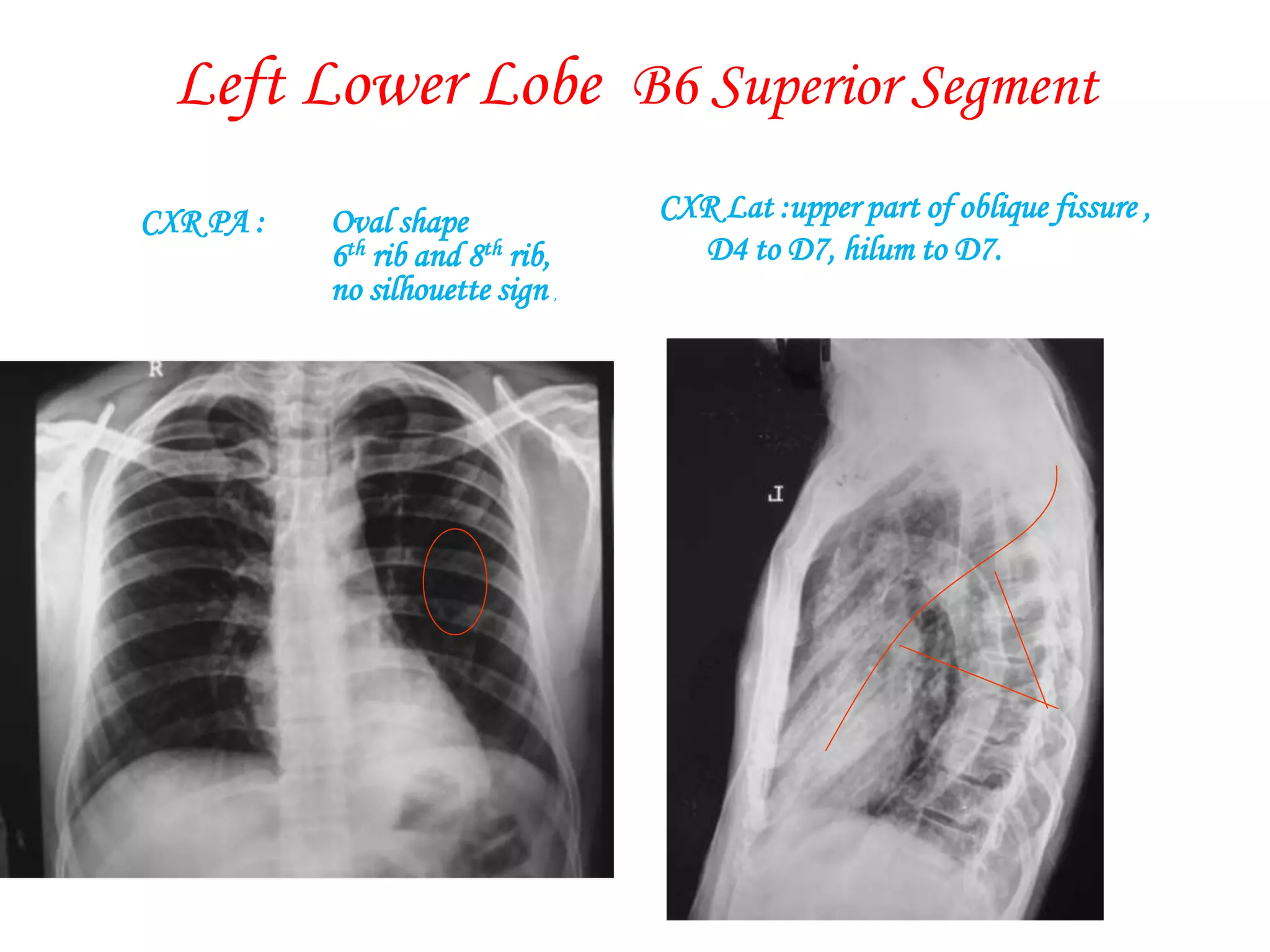 BRONCHOPULMONARY SEGMENTS OF THE LUNG | PPTX