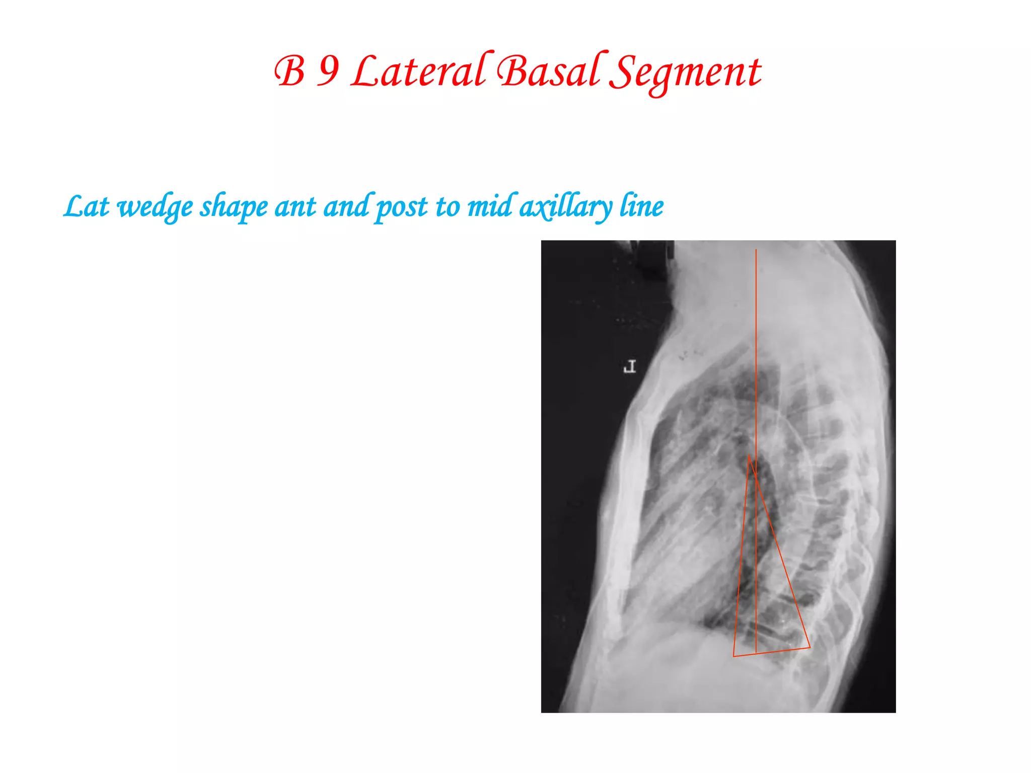 BRONCHOPULMONARY SEGMENTS OF THE LUNG | PPTX