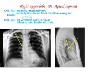 BRONCHOPULMONARY SEGMENTS OF THE LUNG | PPTX