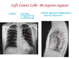 BRONCHOPULMONARY SEGMENTS OF THE LUNG | PPTX