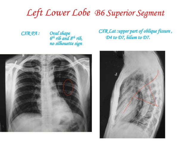 BRONCHOPULMONARY SEGMENTS OF THE LUNG | PPTX | Death, Injury, or ...