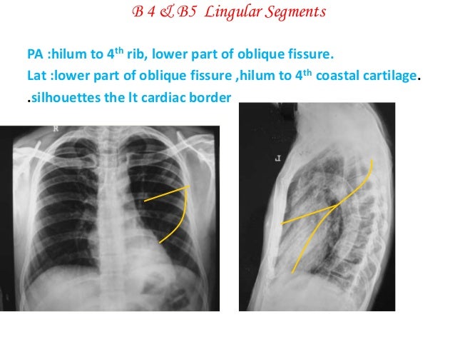Radiopaedia Lung Segments