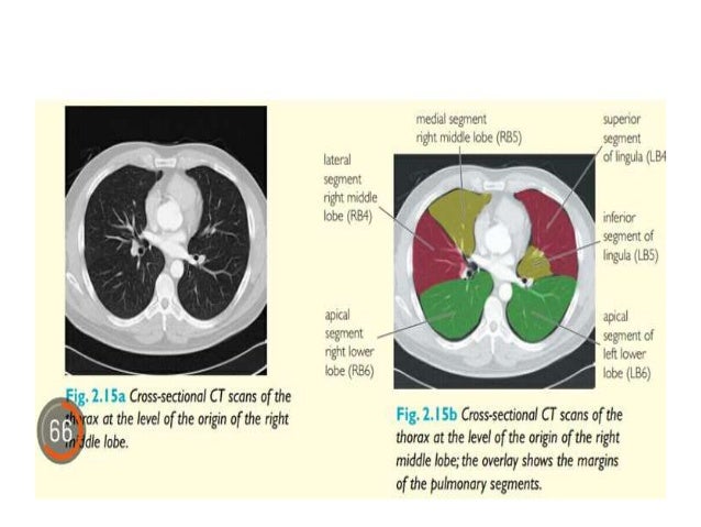 Lung Lobe Anatomy