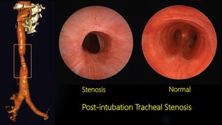 Normal Bronchoscopy
