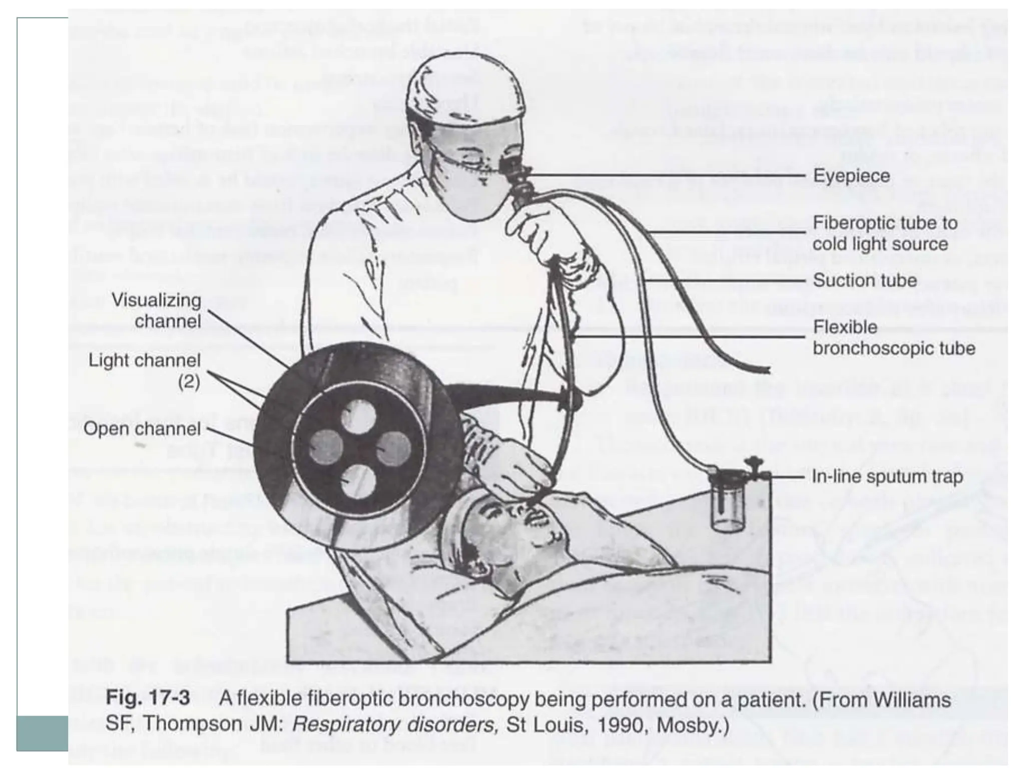 fiberoptic bronchoscopy - airway securing FOI | PPTX