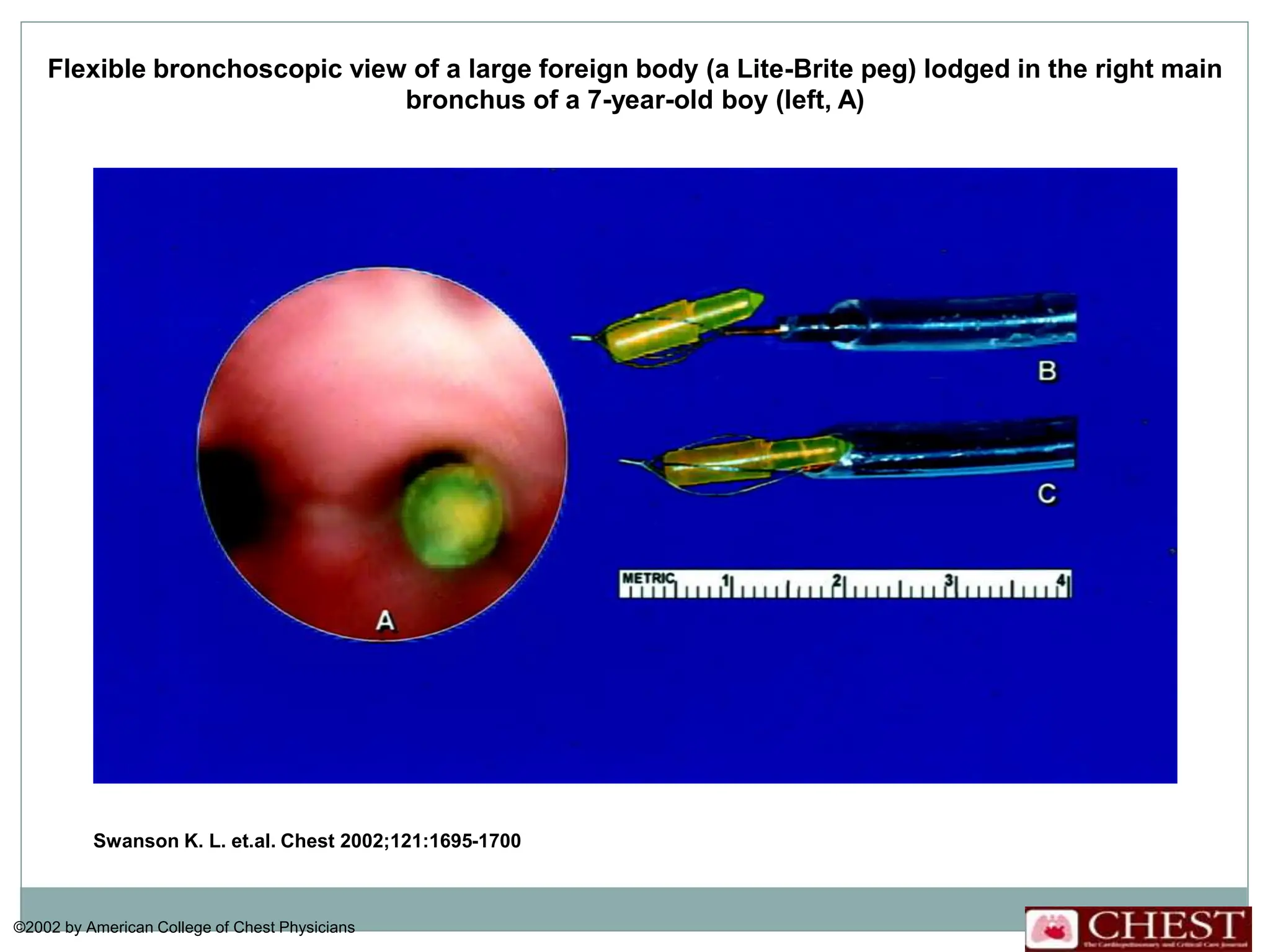 fiberoptic bronchoscopy - airway securing FOI | PPTX