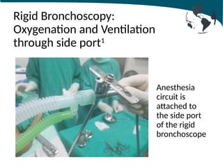 Bronchoscopy_for_Foreign_Body_Anesthetic_Management.pptx