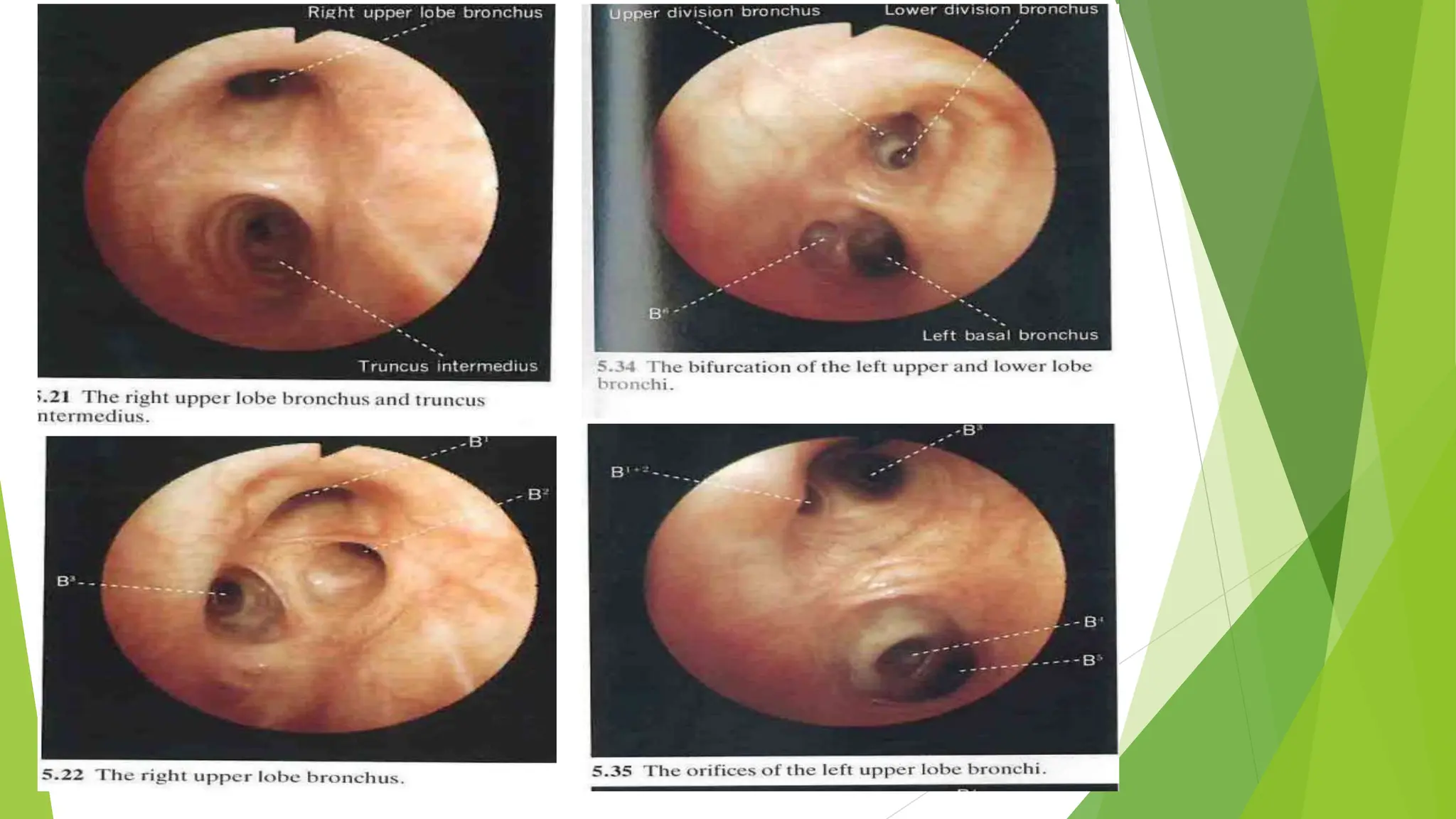 Flexible Bronchoscopy(Basic Diagnostic).pptx