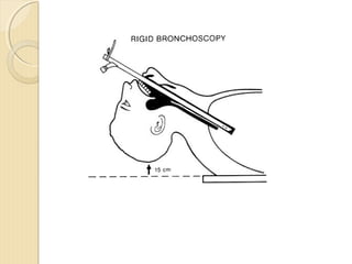 Bronchoscopy ppt | PPT