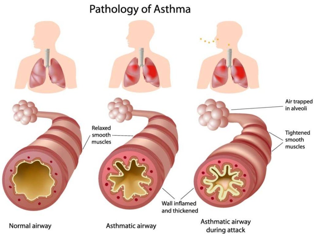 Bronchospasm during induction