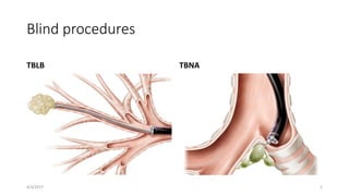 Does a short course in EBUS-TBNA improve yield of conventional TBNA | PPTX