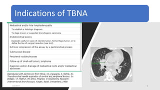 Does a short course in EBUS-TBNA improve yield of conventional TBNA | PPTX