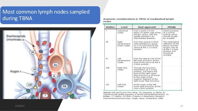 Does a short course in EBUS-TBNA improve yield of conventional TBNA