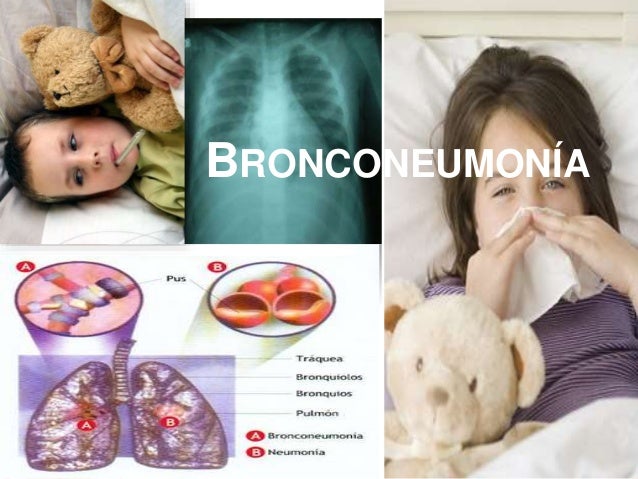 BronconeumonIa