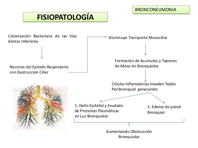 Bronconeumonia y neumonia