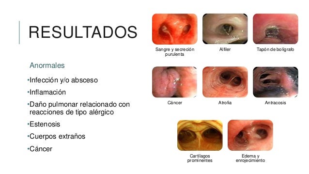 Broncoscopía rígida y flexible y ultrasonografía endobronquial