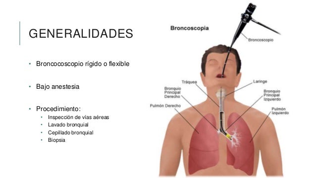 Broncoscopía rígida y flexible y ultrasonografía endobronquial