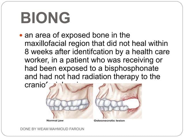 BRONJ bisphosphonates osteonecrosis of jaw | PPTX