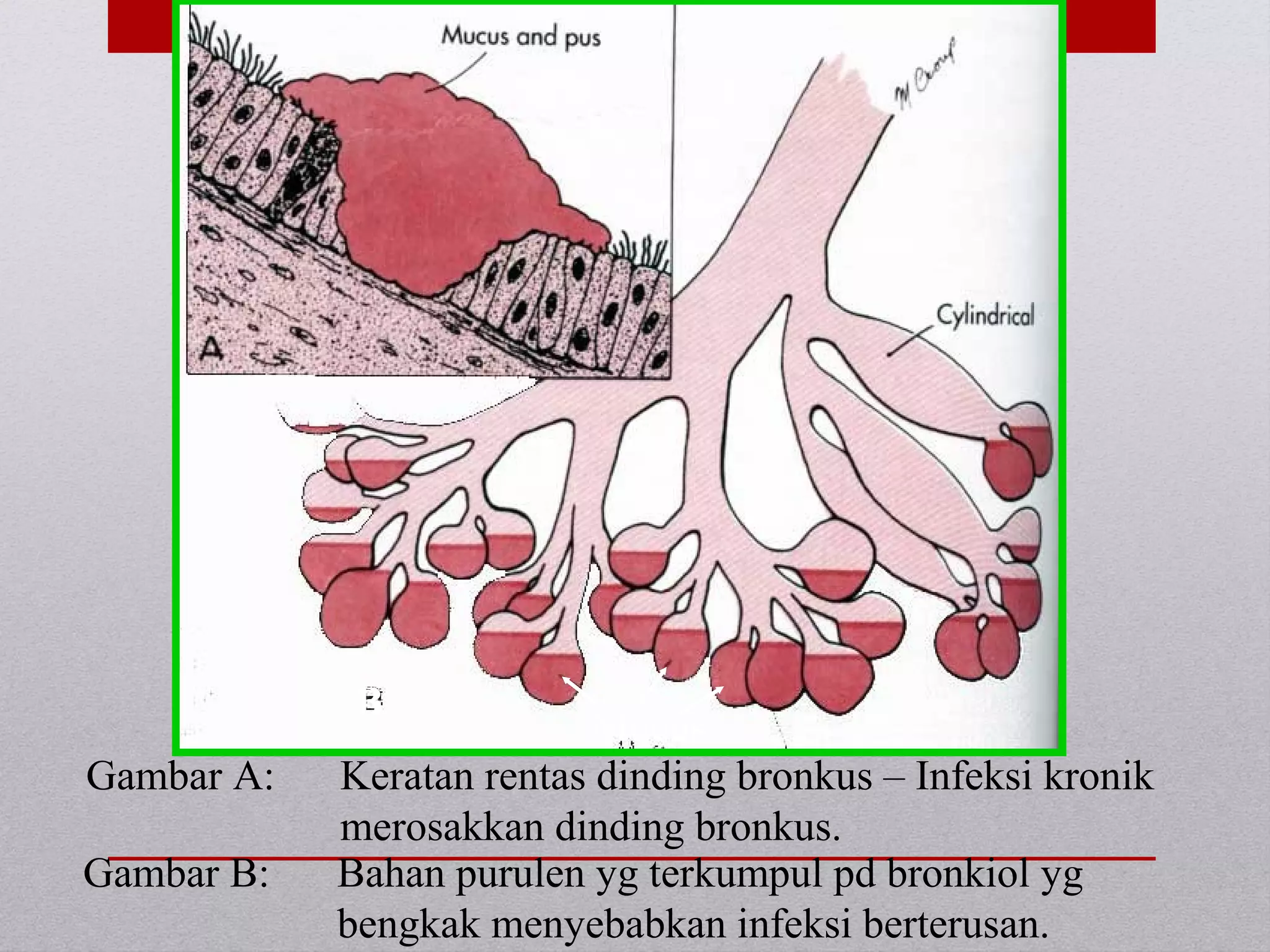 Bronkitis & Bronkiektasis | PPT