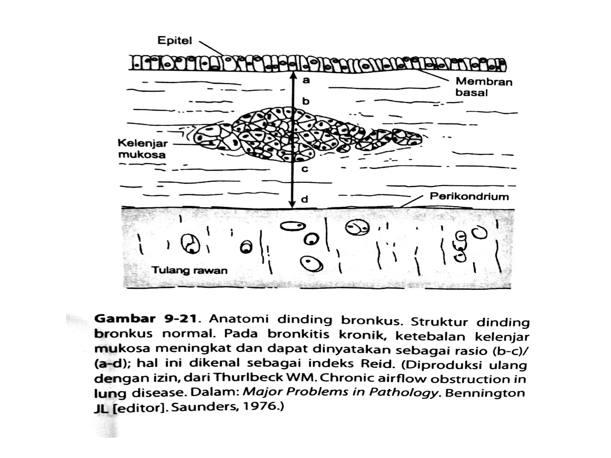 rangkuman materi bronkitis kronis penting .pptx | Lung and Respiratory ...