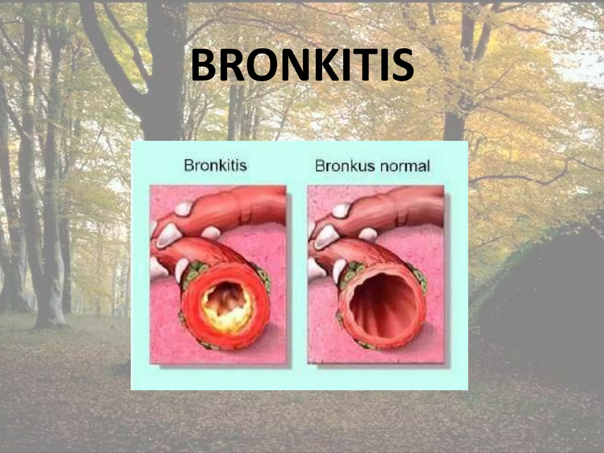 Bronkitis ppt | PPTX