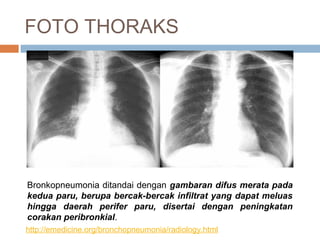 Bronko pneumonia | PPT