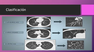 Bronquiectasia Pptx