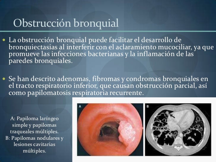 Bronquiectasias
