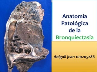 Bronquiectasias Pptx