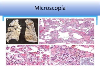 Bronquiectasias Pptx
