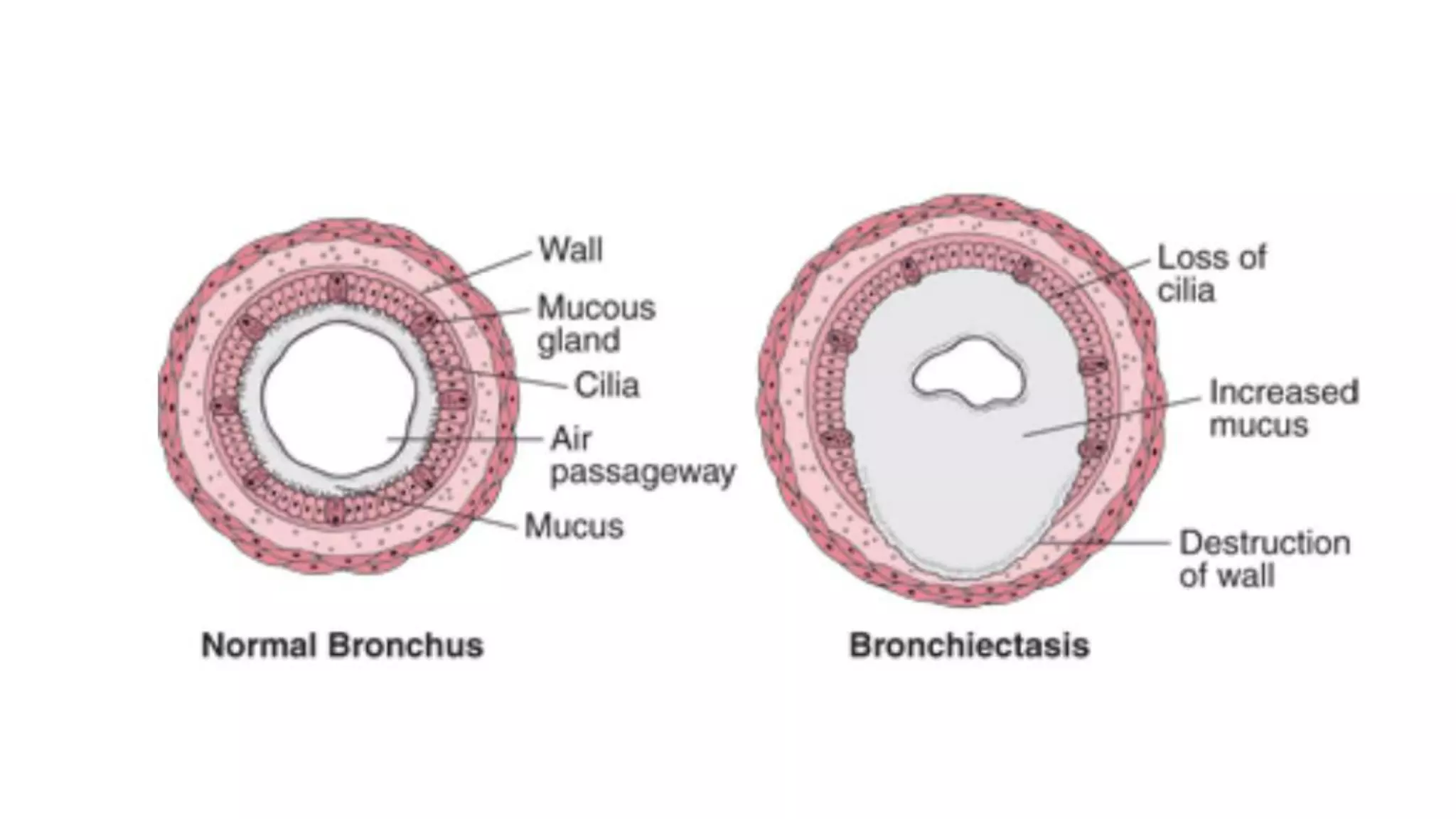Bronquiectasias Pdf Lung And Respiratory Health Diseases And