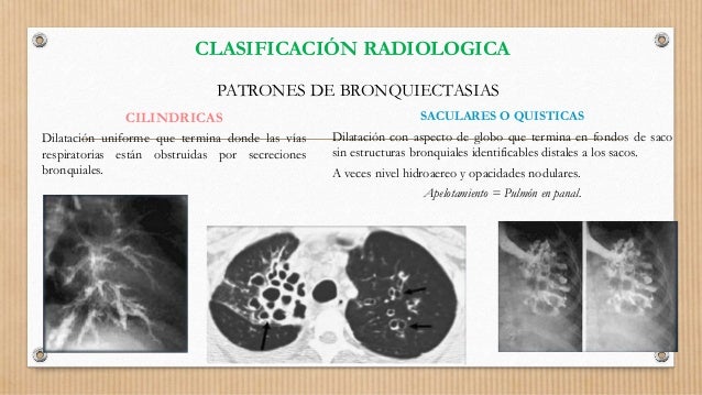 Bronquiectasias Curso Clinico Y Tratamiento
