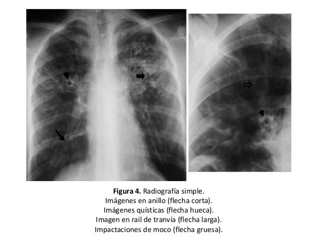 Bronquiectasia y patrón vascular