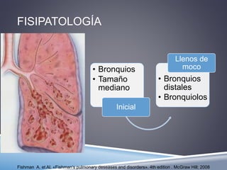 Bronquiectasis | PPTX