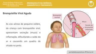 Bronquiolite na Infância: diagnóstico e tratamento | PDF