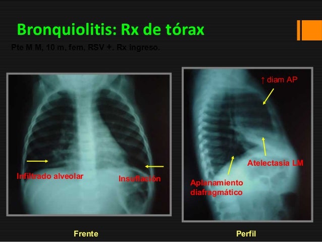 Bronquiolitis