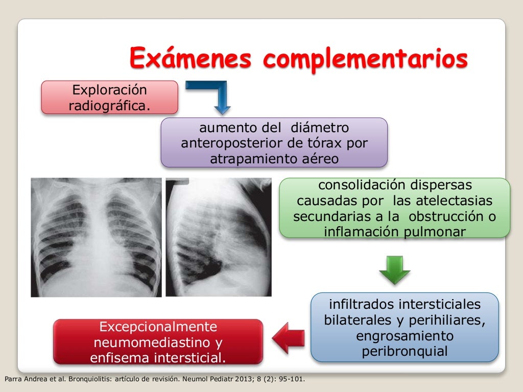 Bronquiolitis Pediatría
