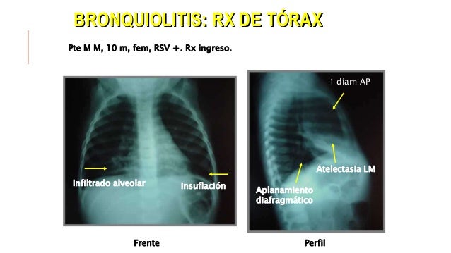 Bronquiolitis