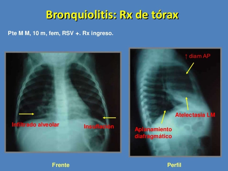 Bronquiolitis