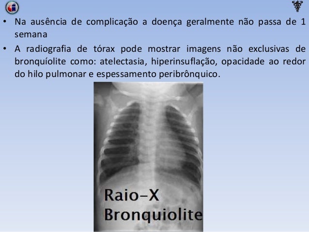 Bronquiolíte viral viral aguda