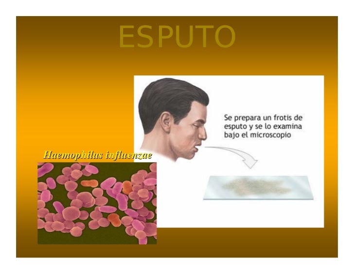 Bronquitis Crónica