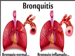 Bronquitis | PDF | Lung and Respiratory Health | Diseases and Conditions