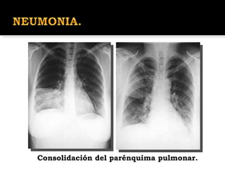 Bronquitis Aguda Pulmones