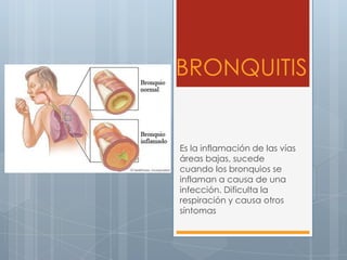 Bronquitis aguda | PPTX